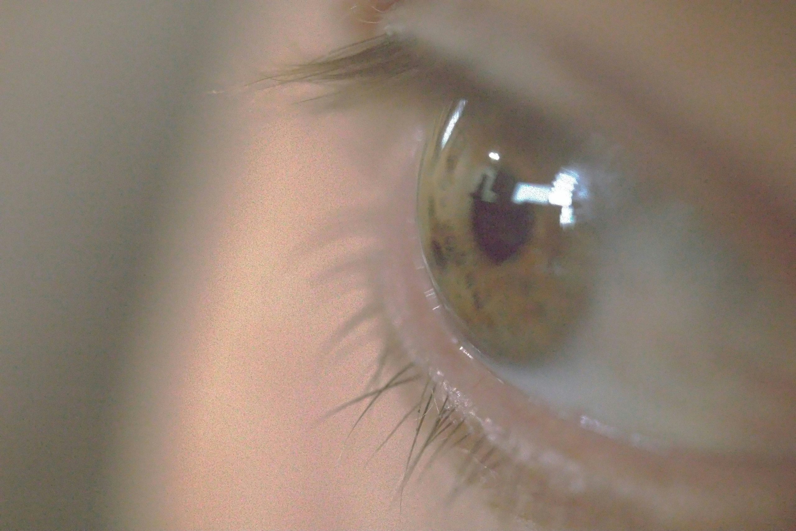 Why Are My Eyelashes Falling Out? | Causes & Treatment